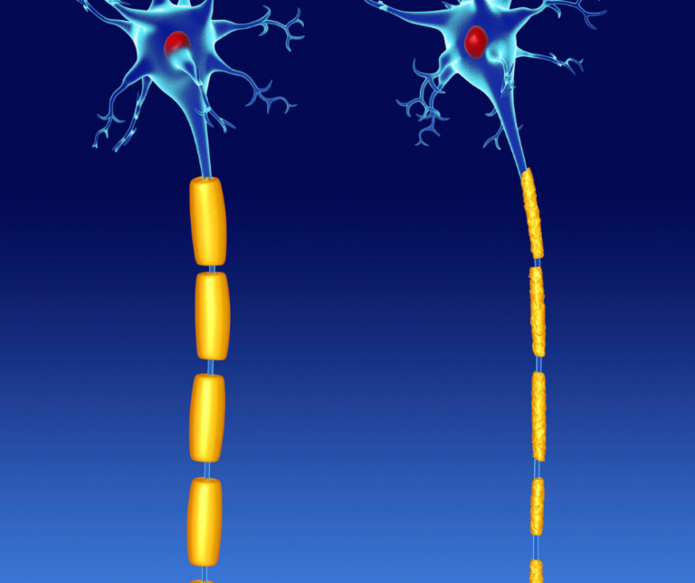 Stwardnienie rozsiane w pigułce | Baza wiedzy - Dobro Powraca